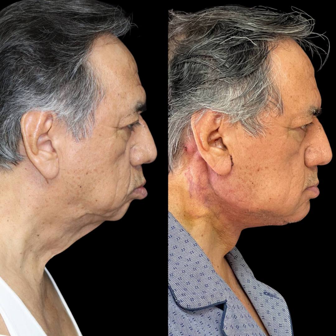 Dr.Bueso – Rinología y Cirugía Plástica Facial. Otorrinolaringología ...